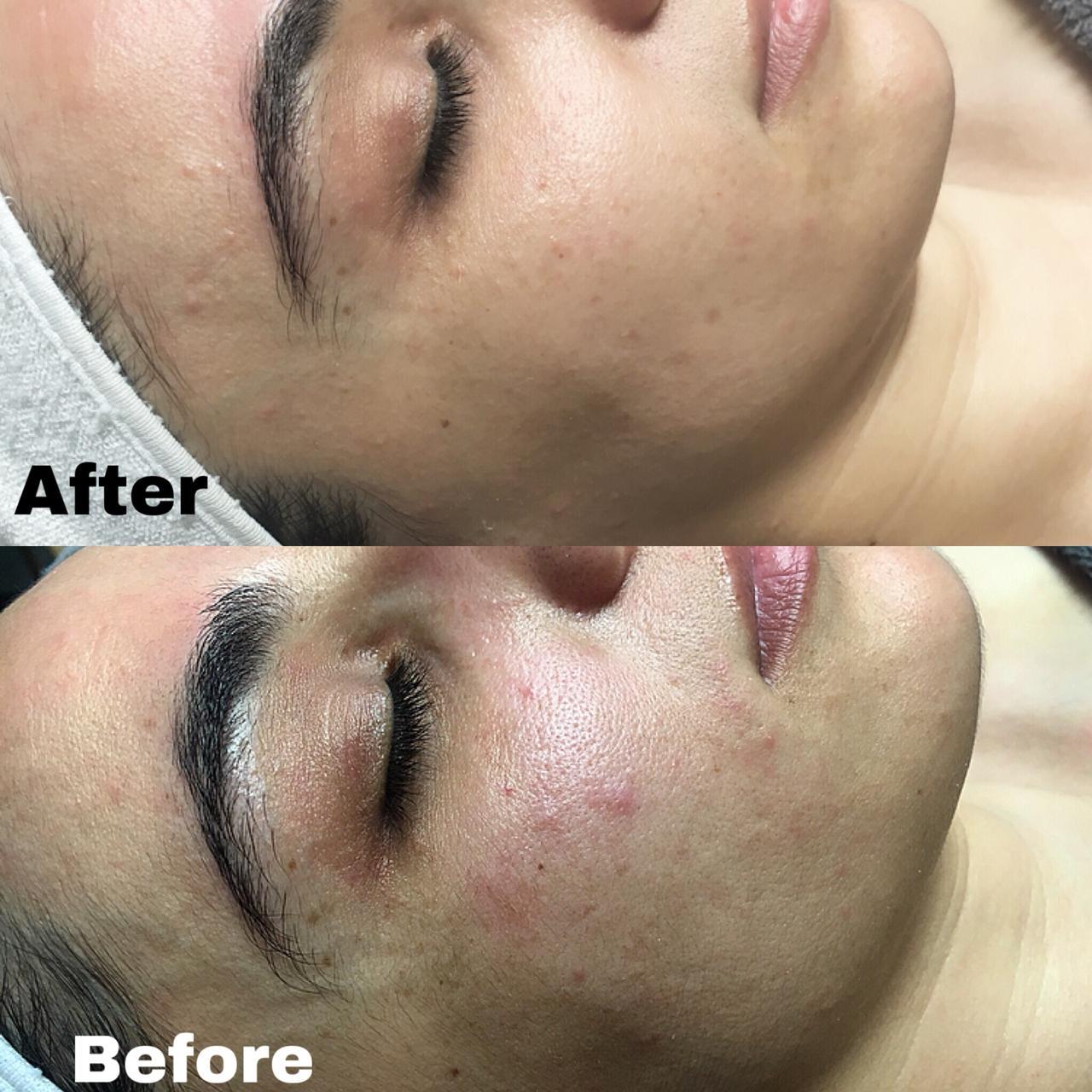 The Ultimate Solution for Skin Rejuvenation! – Spala South Africa